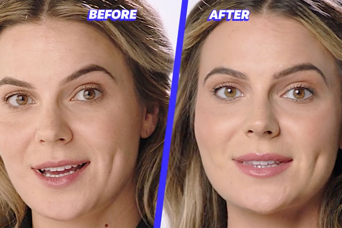 Juvederm in Greenville, SC | Greenville Facial Plastic Surgery