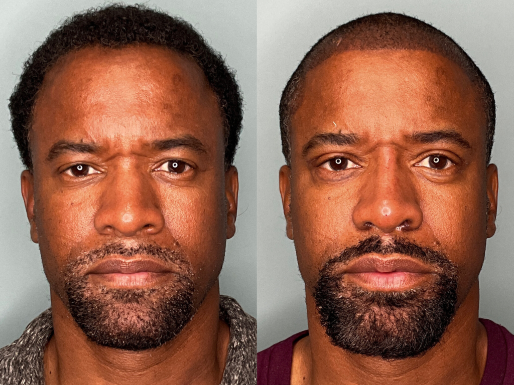 Gallery | Greenville Facial Plastic Surgery